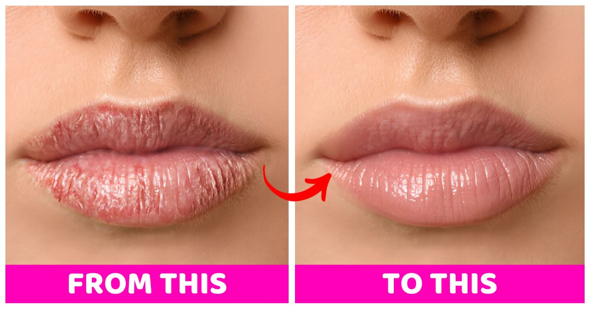 How To Get Rid Of Dry Lips: The Best Homemade Remedies - Woman & Lifestyle