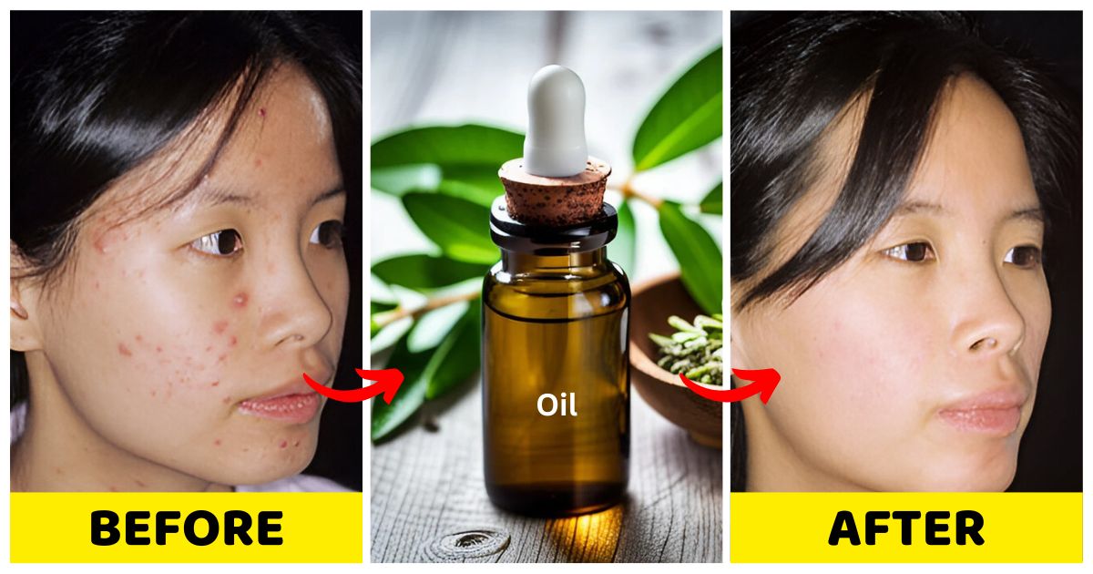 Hard Pimples And How To Get Rid Of Them With Home Remedies - Woman ...