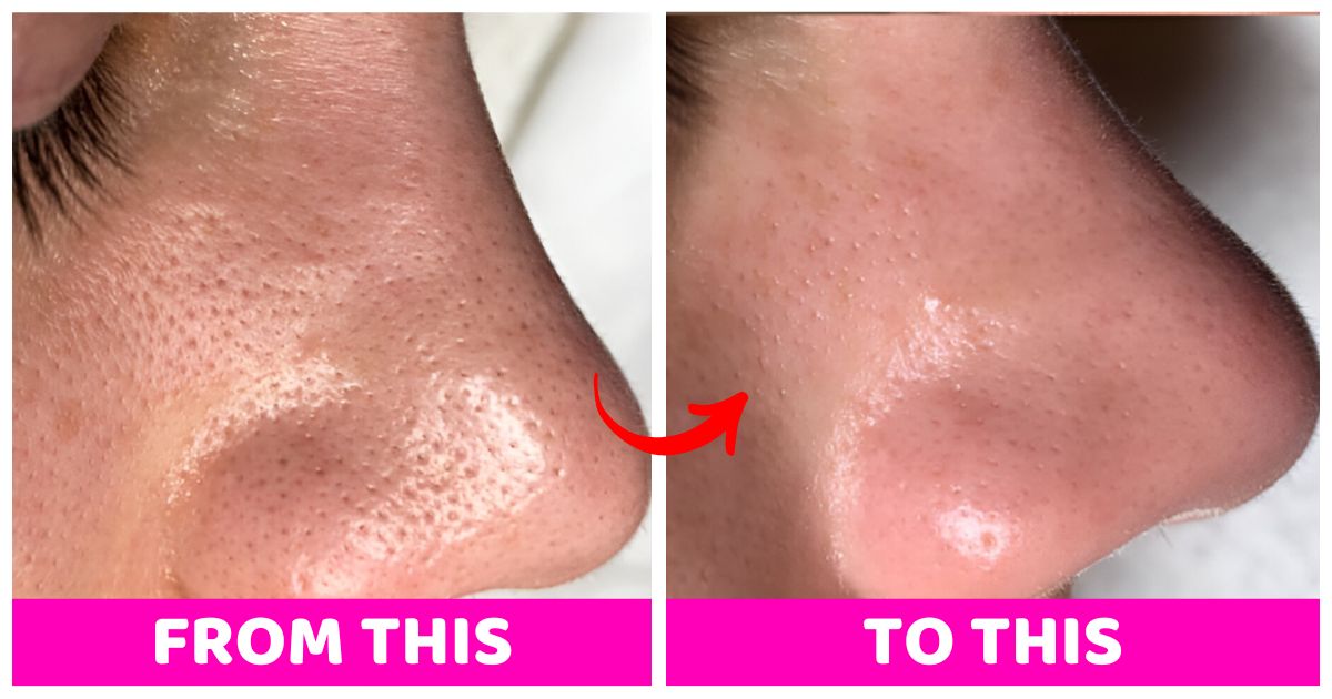 Get Rid Of Excessive Oily Nose: The Ultimate Guide You Need - Woman ...