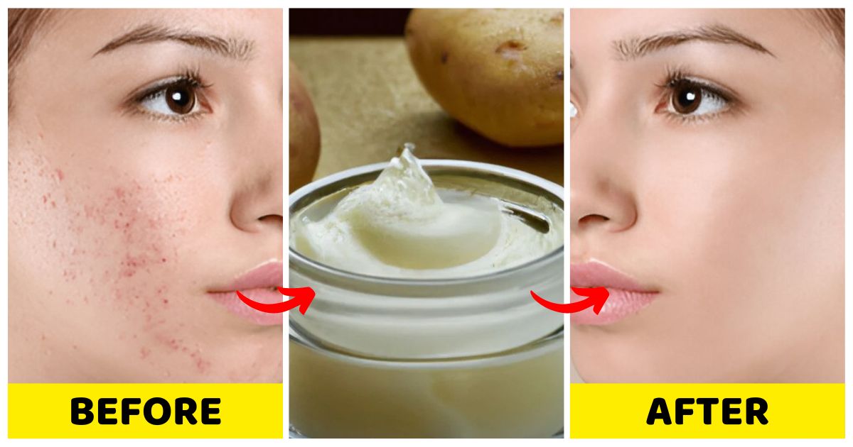 5 Simple Potato Face Packs To Heal Your Skin And Make It Glow - Woman ...